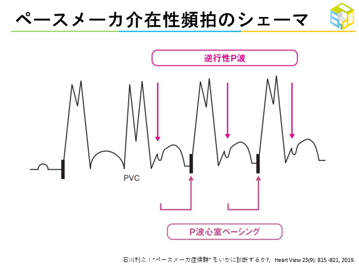 ペースメーカ起因性頻拍（PMT）のメカニズムとは？ | 自費訪問リハビリなら エポック